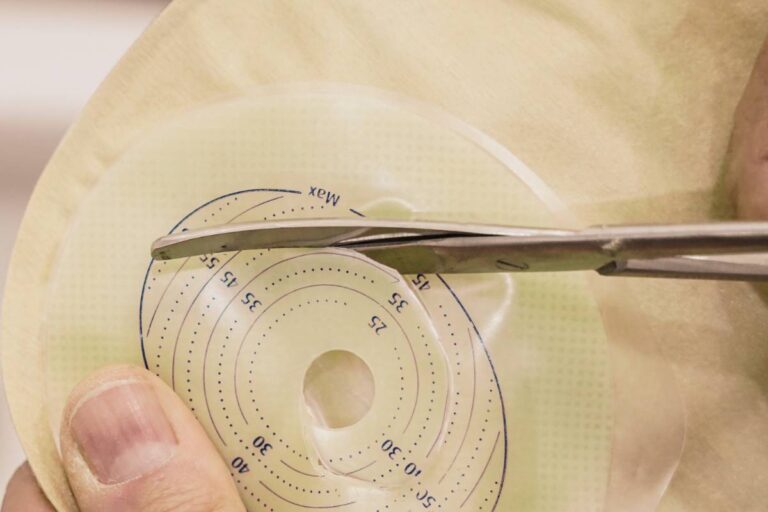 Stoma Crusting Technique Step By Step Guide Ostomyonthego